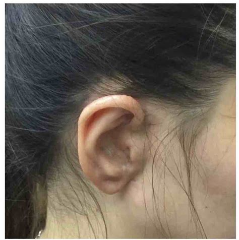 Auricular Prosthesis 2 Louis Hofmeyr