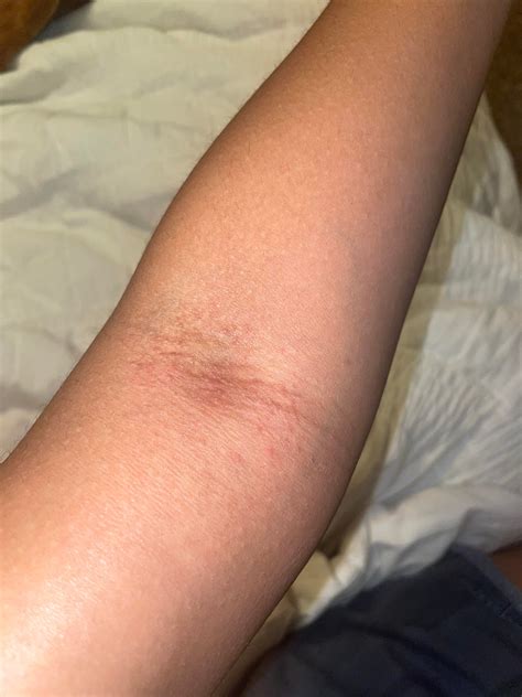 Random Rash In Elbow Crease R Dermatology