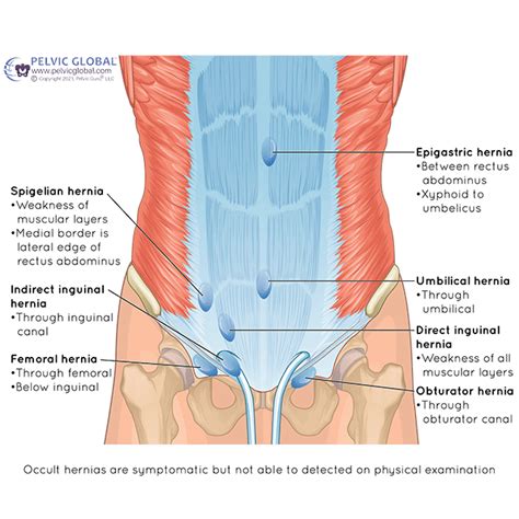 Umbilical Hernia In Adults After Pregnancies Hernia After Pregnancy