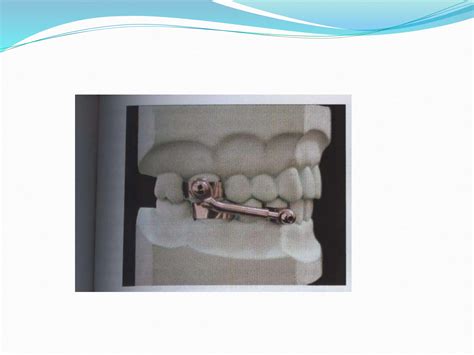 Fixed Functional Appliances In Orthodontics Pptx
