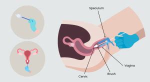 What You Need To Know About The HPV Self Collection Test NCCC