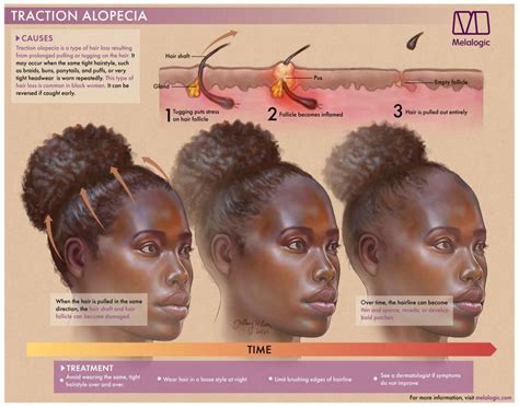 Traction Alopecia