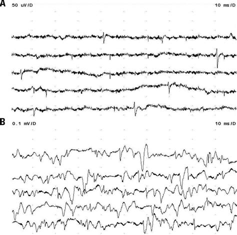 Needle Electromyography Of The Right Brachial Biceps Muscle A