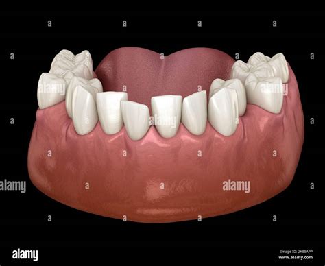 Overcrowded Teeth Abnormal Dental Occlusion Medically Accurate Tooth