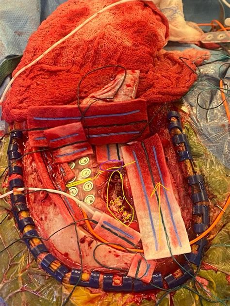 Successful Resection Surgery On Monday With Pics R Epilepsy