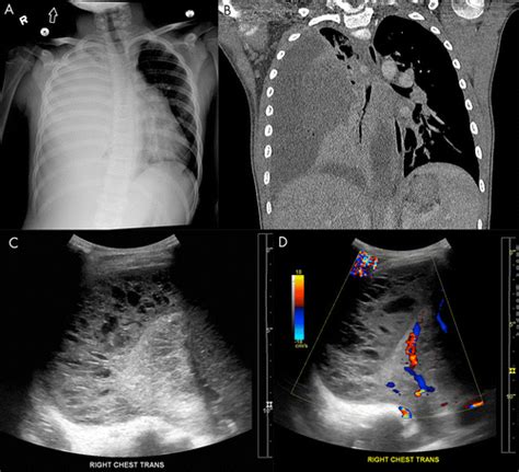 Hepatization Of Lung