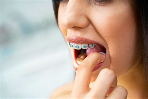 What Is The Purpose Of Rubber Bands In Braces Treatment Master Orthodontics