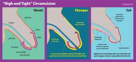 Circumcision Styles And Differences 2025 Sünnetli Deriyi Uzatma