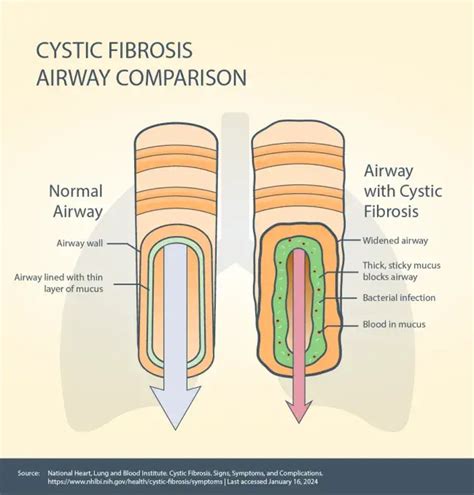 Living With Cystic Fibrosis