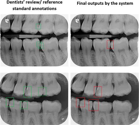 Evaluation Of A Deep Learning System For Automatic Detection Of Proximal Surface Dental Caries