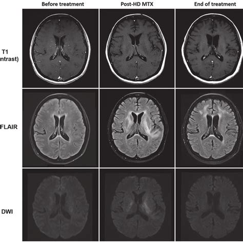 Serum Methotrexate Level And Onset Of Neurological Manifestations A Download Scientific