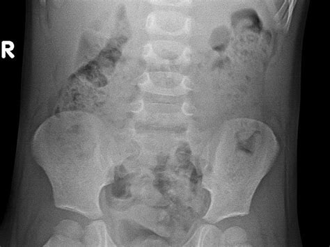 Constipation On X Ray Images