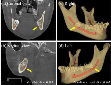 An Example Of Mandible And Mandibular Canal Segmentation Results