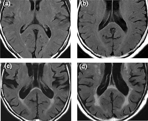 Flair Hyperintensities In The Anterior Part Of The Callosal Splenium In