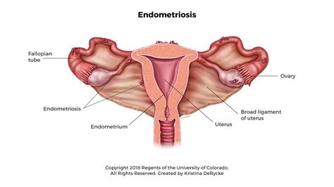 Endometriosis Womens Health Action