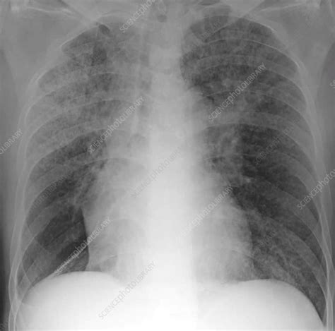 Miliary Nodules X Ray Stock Image F0356546 Science Photo Library