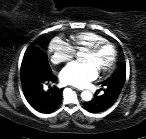 Computed Tomography CT Scan Performed Before The Embolectomy Download Scientific Diagram