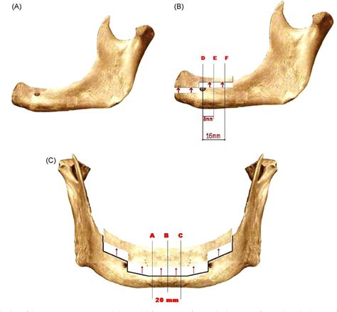 In Visor Osteotomy At Brittany Wertz Blog