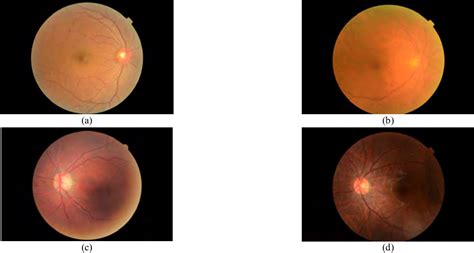Figure From Classification Of Ocular Diseases On Fundus Images Using Weighted MobileNetV