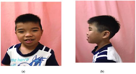 Physical Appearance Of A 5 Year Old Boy With Wss Dysmorphic Facies