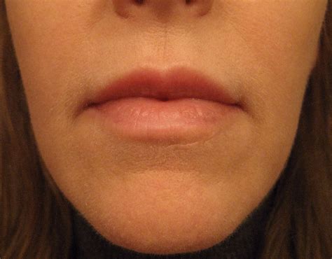 Chemical Peels For Acne And Anti Aging 6th Tca Chemical Peel Before