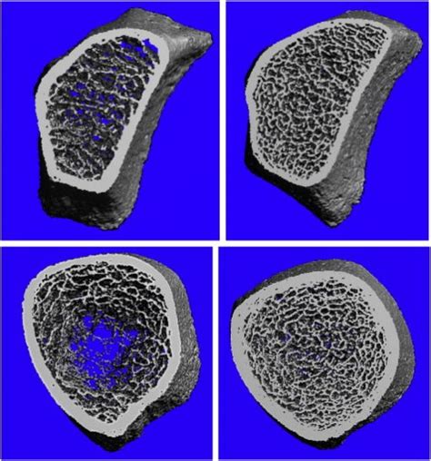 Bone Microarchitecture And Structure In Patients With AS MATLAB Number ONE