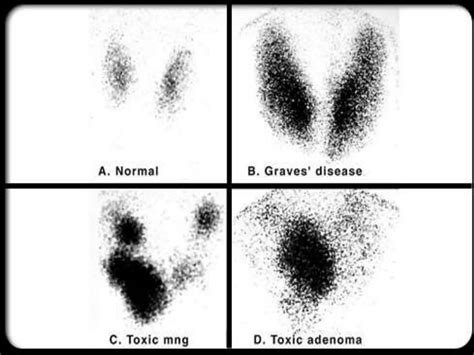 Nuclear Medicine Thyroid Procedure Scan Pptx