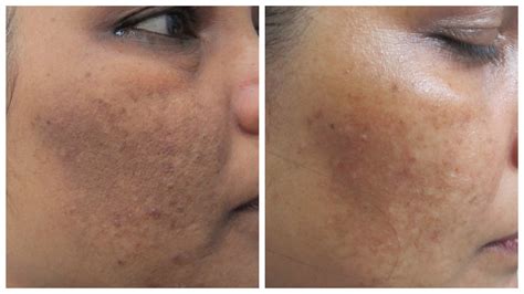 Can Freckles Get Darker During Pregnancy Heres What You Need To Know