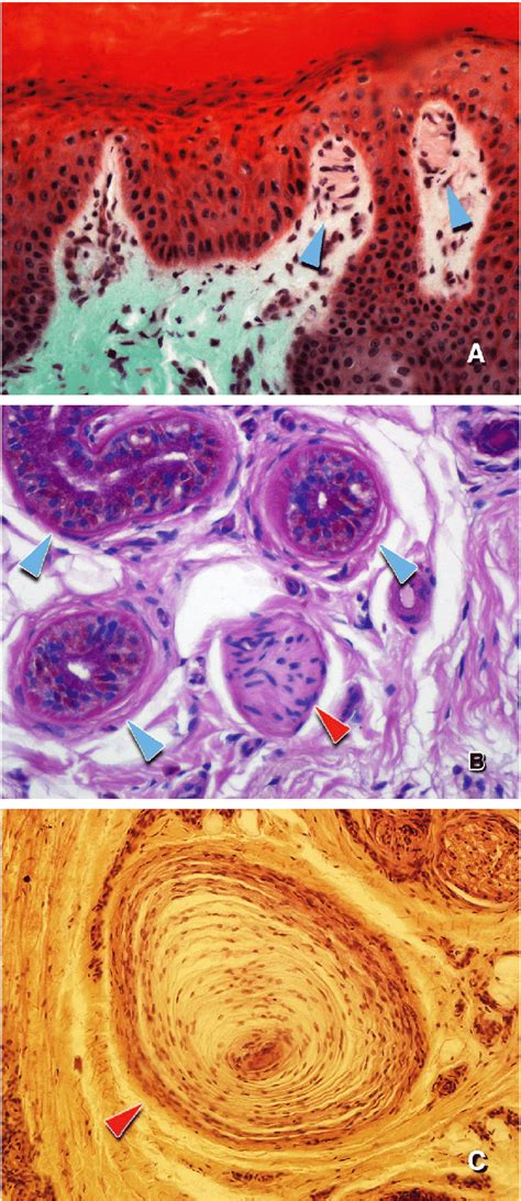 Pacinian Corpuscle Vs Meissners Corpuscle