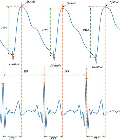 What Is Plethysmogram Wave At Tracy Worsley Blog