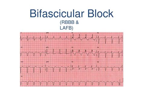 PPT Bundle Branch Blocks PowerPoint Presentation Free Download ID