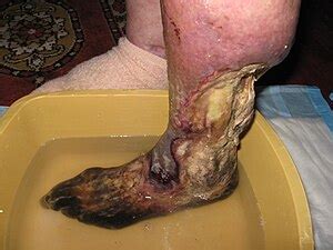 Gangrene Wikilectures
