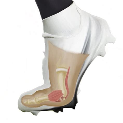 Dorsal Midline Incision With Weil Osteotomy And Distraction Of The