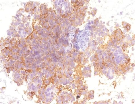Synaptophysin Immunostaining Of Pnet Biopsy Obtained Through Eus Fnb Download Scientific