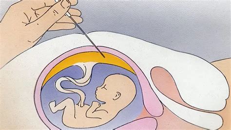 Safe Method Of Detecting Downs Syndrome In A Fetus Healthy Food Near Me
