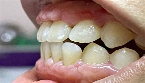Gingival Enlargement Following Levetiracetam Treatment A Clinical Case