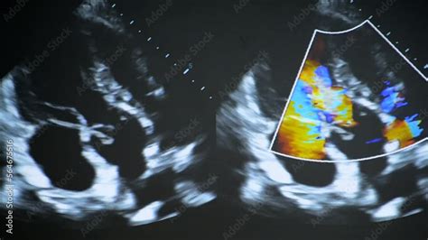 Utrasound Image On The Monitor Close Up Ultrasound Scan Display Screening Ultrasonography