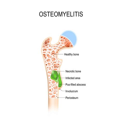 Diagnosis And Treatment Of Osteomyelitis In Chronic Wounds