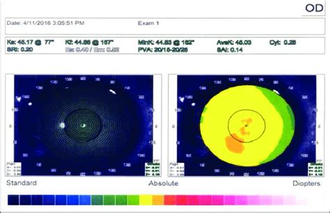 Preoperative Map Showing A Normal Corneal Topography Map Of The Right