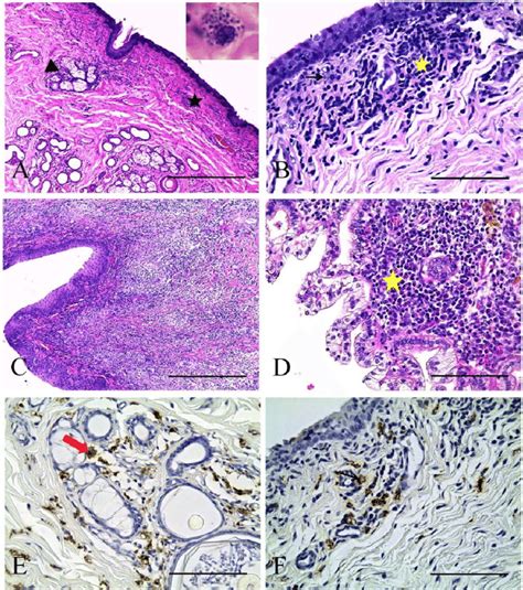 A Vulva Diffuse Moderate Chronic Inflammatory Infiltrate In Download Scientific Diagram