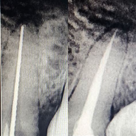 Dr Huma Abbasi On Linkedin Unlocking The Secrets Of Tooth Preservation Through The Art Of