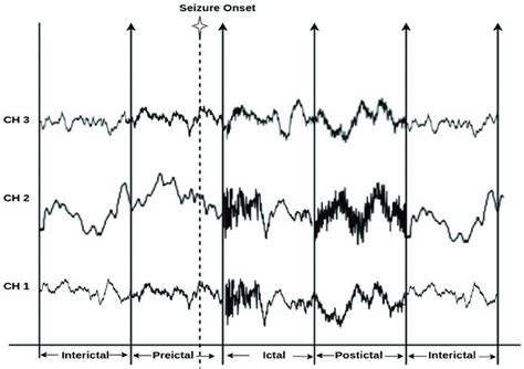 Diagram Of Epilepsy Stages Download Scientific Diagram