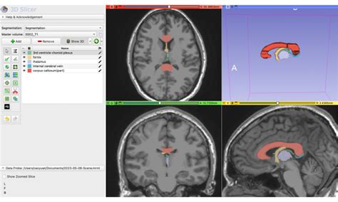 Manual Segmentation Of The Human Choroid Plexus Using Brain MRI Scientific Article Protocol JoVE