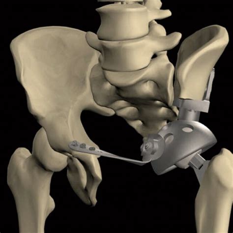 Preoperative Planning For Reconstruction Of Left Hip Due To Severe Download Scientific Diagram