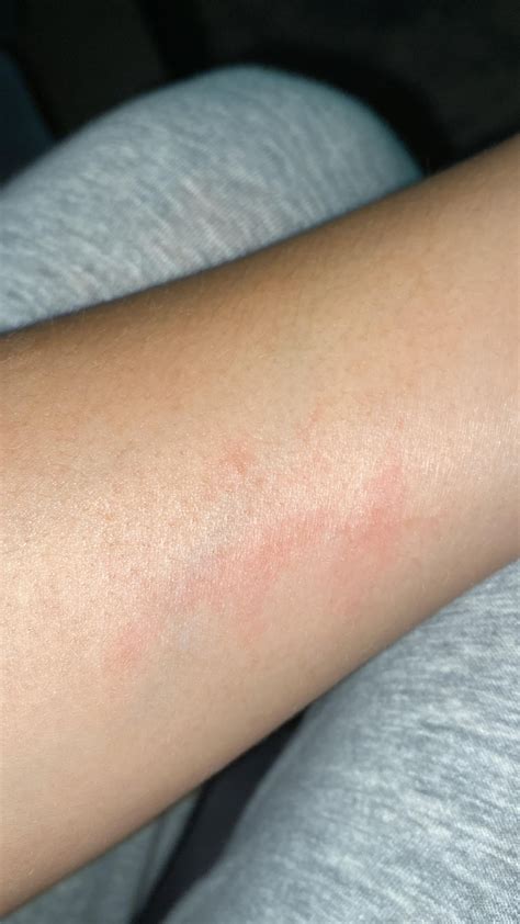 Ivermectin And Alcohol Rscabies