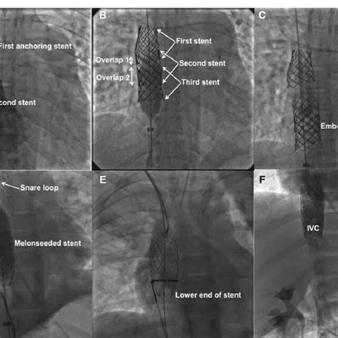Stent Migration Needing Surgery After A First Anchoring Covered Stent Download Scientific