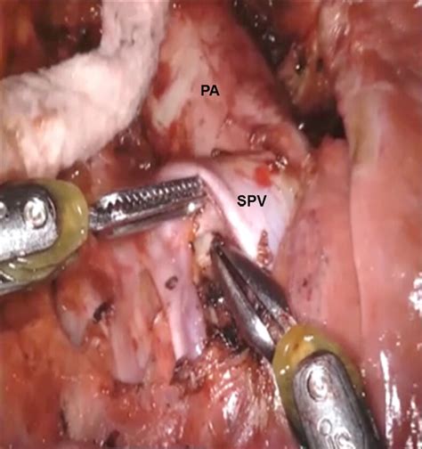 Ls3 Segmentectomy The Nodes Between The Spv And The Pa Are Dissected