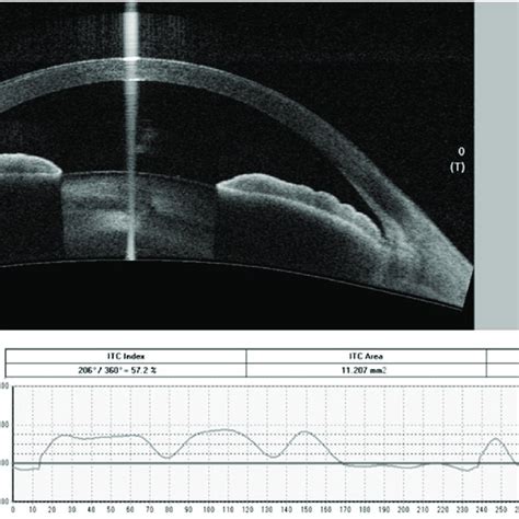 The Iris Trabecular Contact Itc Index Analysis A Ss Oct Meridional
