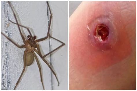Cómo Reconocer Los Síntomas De Una Picadura De Araña Venenosa
