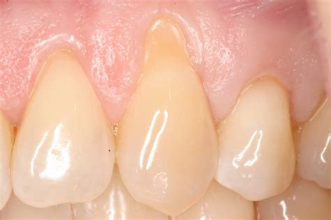Root Coverage Grafting Orange CA Michael J Arzouman D D S Inc
